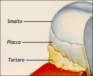Studio dentistico Romano - Placca e tartaro